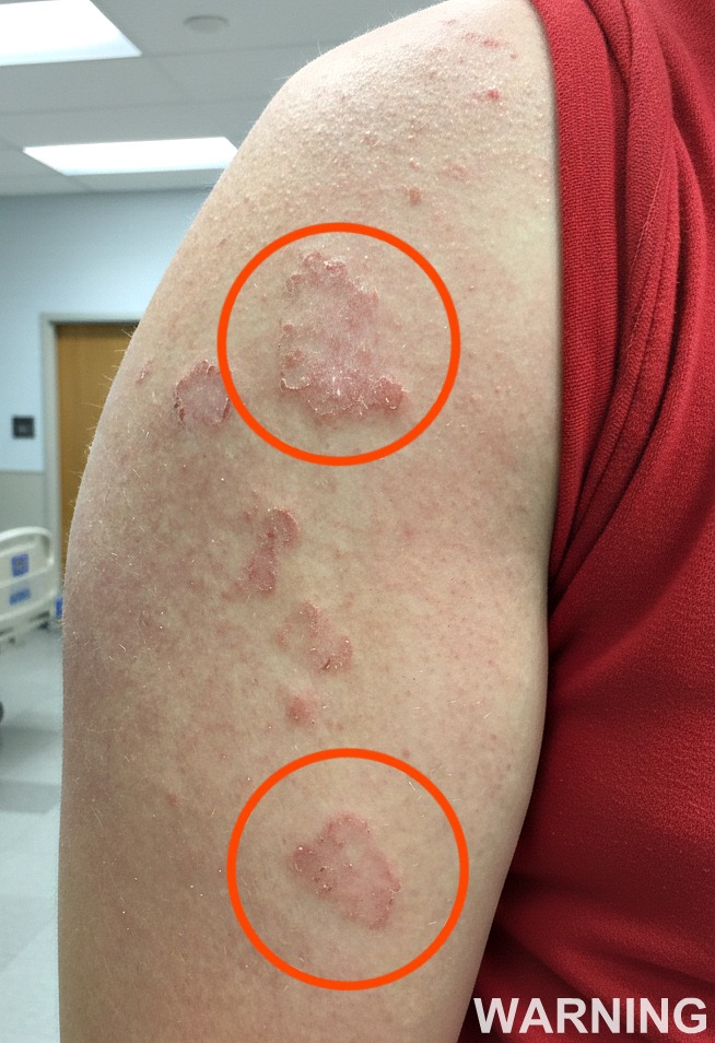 If you see red marks appearing on your arm, that’s a sign of ca… See ...